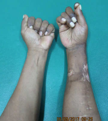 Trauma: Chronic Volkmann’s Contracture (48232) – CSC Staff Teaching and ...