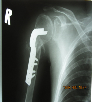 Trauma: Plate failure, non-union and locking plates (000178) – CSC ...