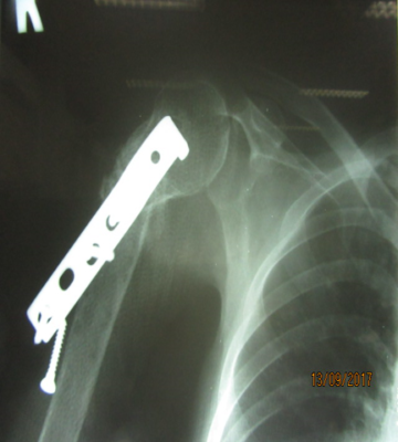 Trauma: Plate failure, non-union and locking plates (000178) – CSC ...