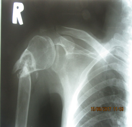 Trauma: Plate failure, non-union and locking plates (000178) – CSC ...